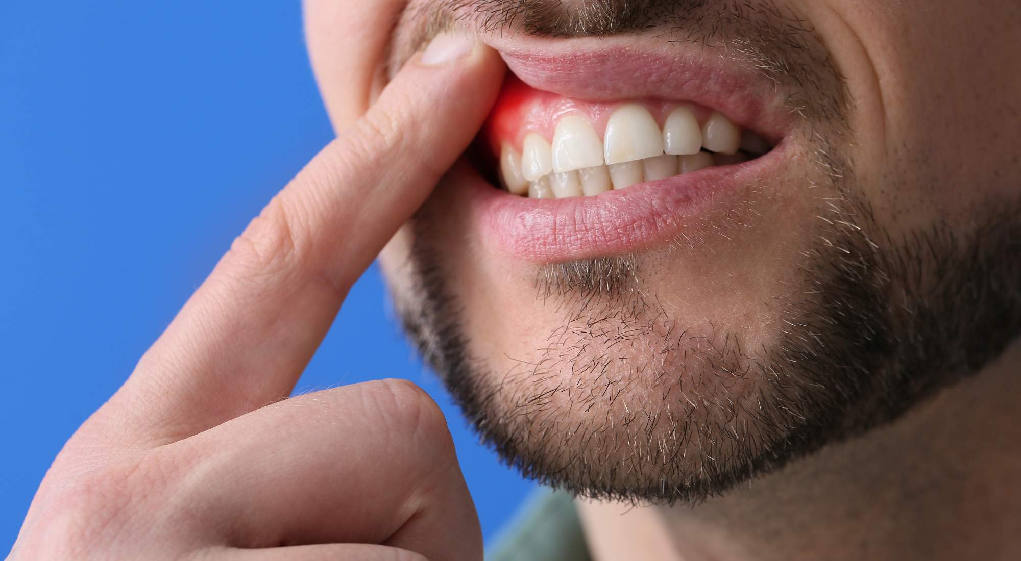 What Causes Sensitive Gums? Treatments for Your Sore Mouth